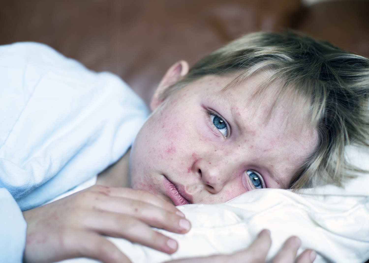 Rougeole: causes, symptômes et traitements