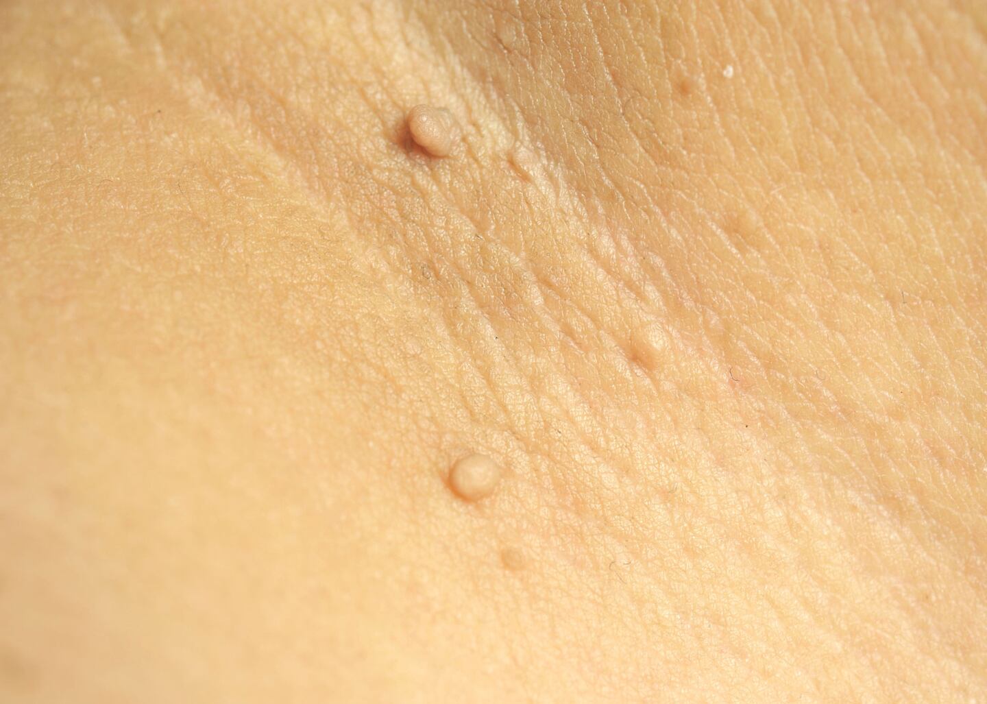 Acrochordon: symptômes, traitements et prévention