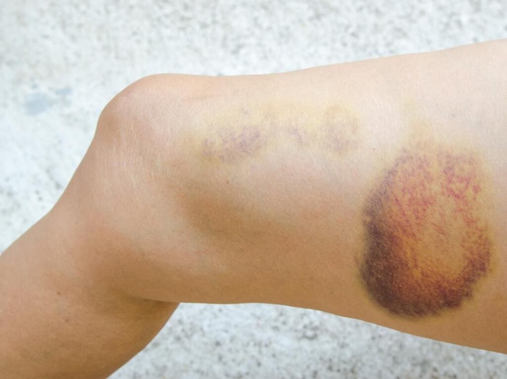 Bleu, ecchymose, hématome: différences, causes et traitements