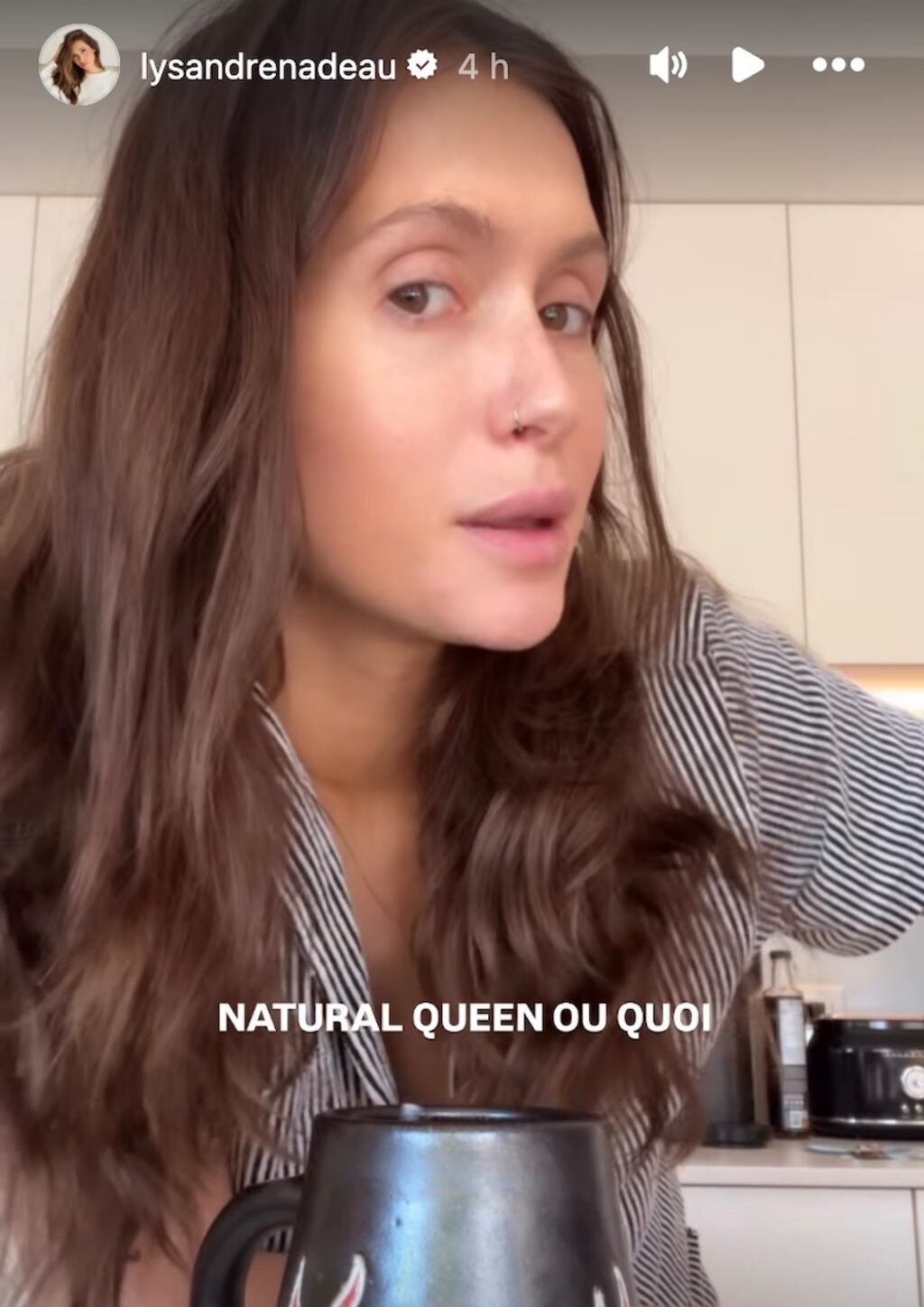 Retour au naturel: Lysandre Nadeau a fait fondre ses injections au visage
