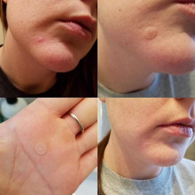 Ces timbres anti-acné font de vrais petits miracles pour diminuer l ...